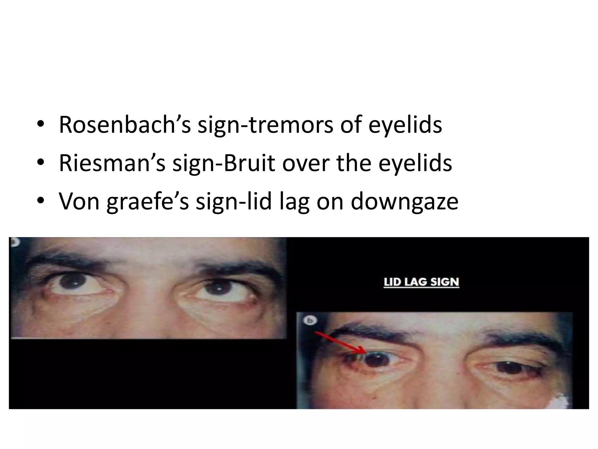 Thyroid ophthalmopathy | PPTX
