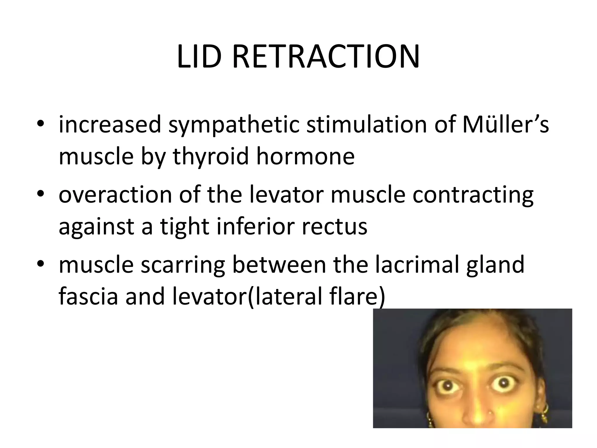 Thyroid ophthalmopathy | PPTX
