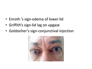 Thyroid ophthalmopathy | PPTX