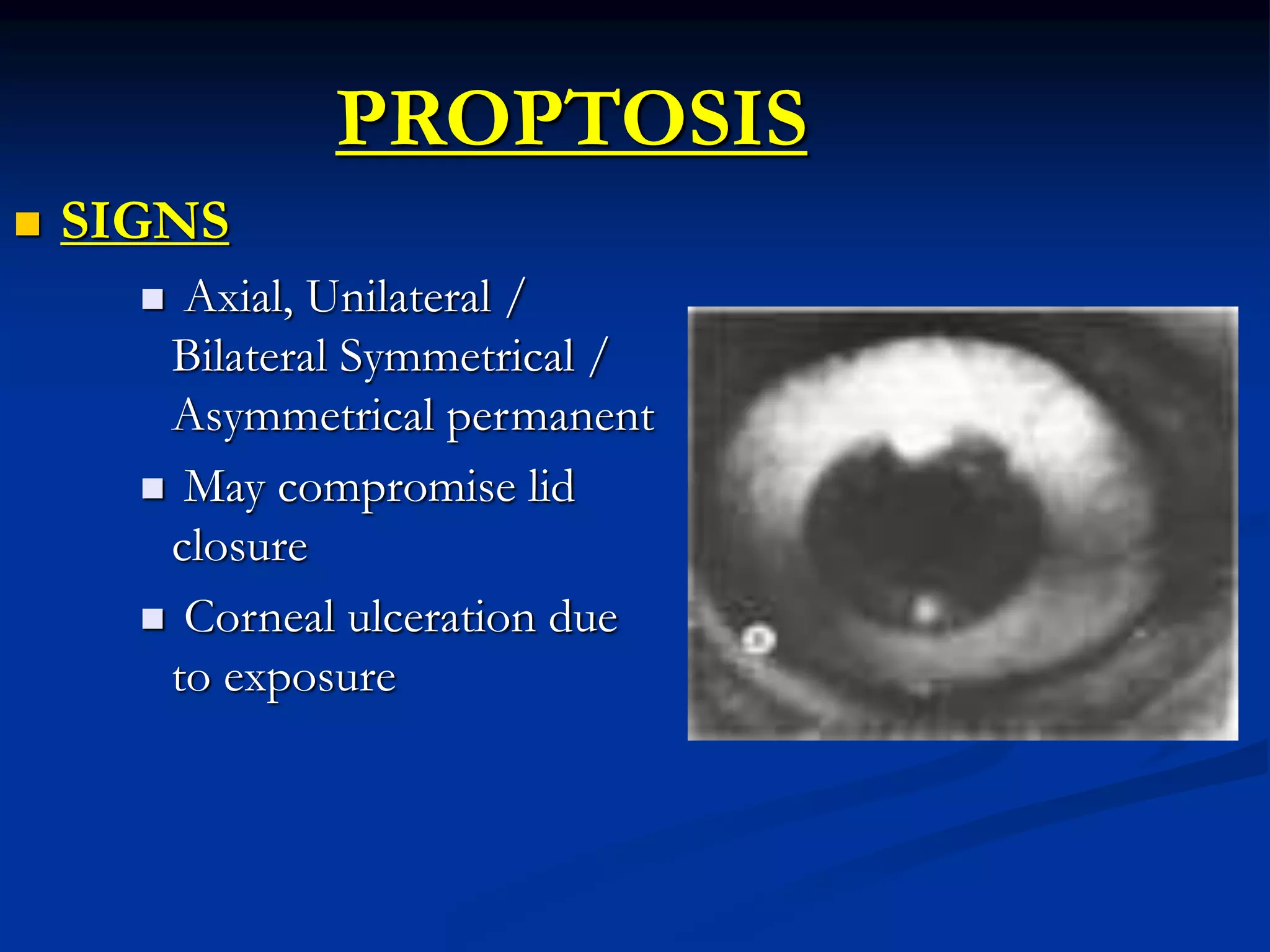 THYROID OPHTHALMOPATHY.ppt