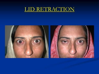 THYROID OPHTHALMOPATHY.ppt | Thyroid Disorders | Endocrine and ...