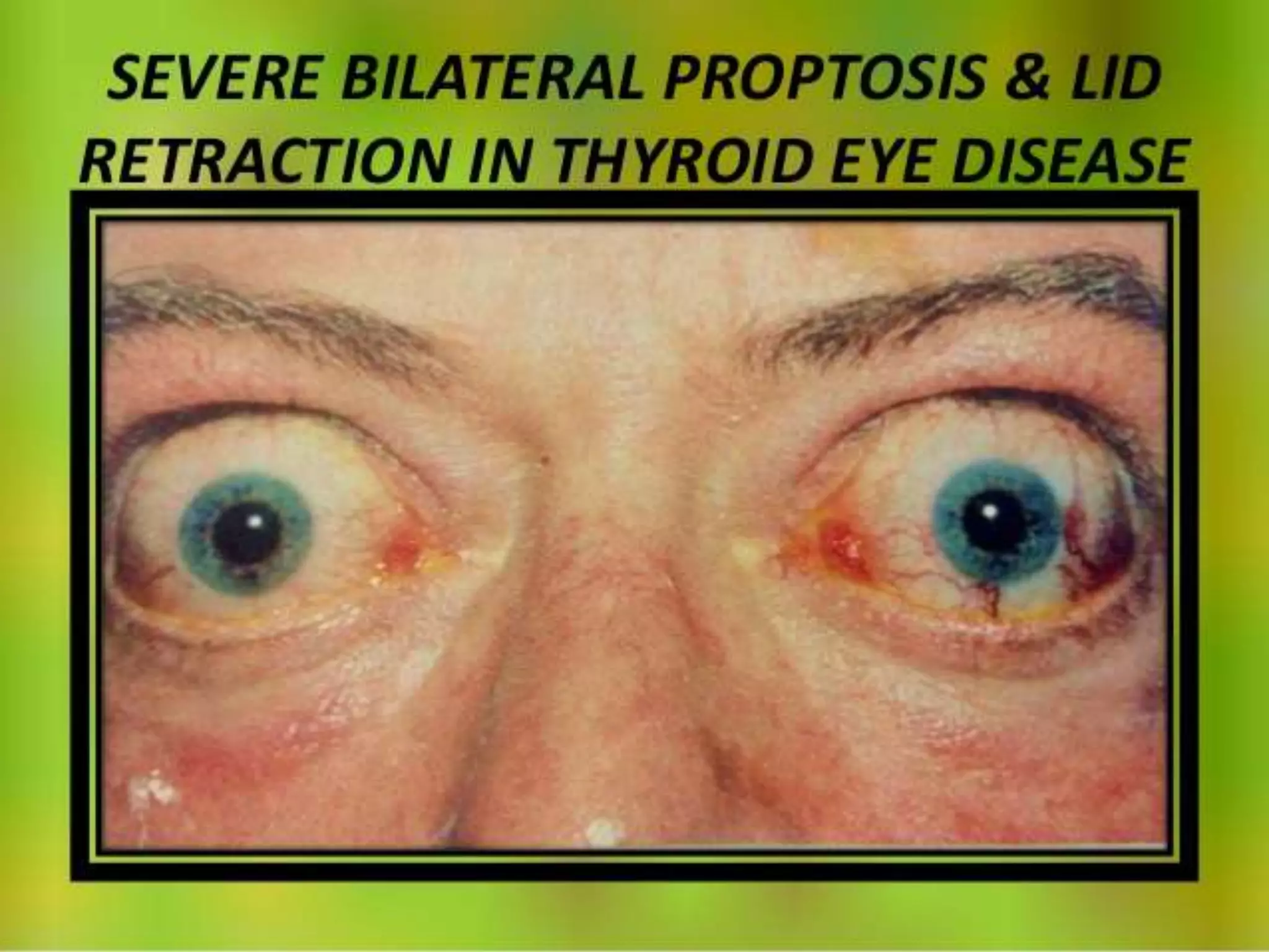 Thyroid opthalmopathy | PPTX