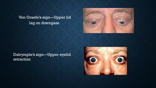 Presentation on THYROID ORBITOPATHY diseases | PPTX