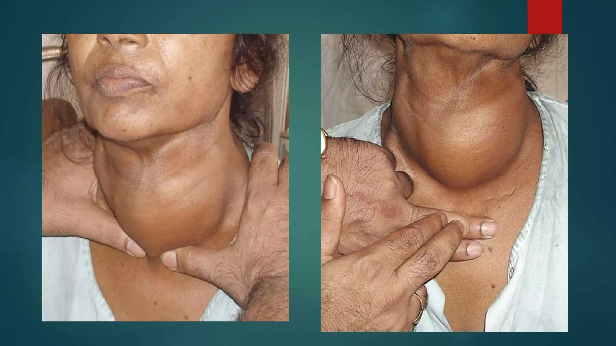 Thyroid Palpation | PPTX