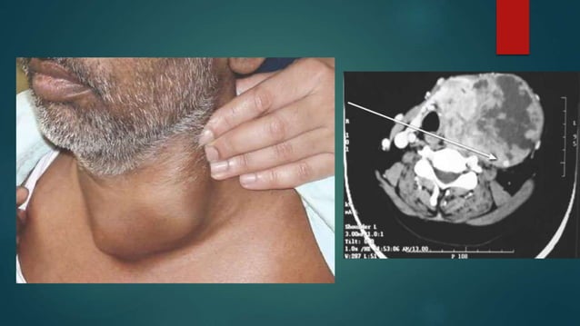 Thyroid Palpation | PPTX