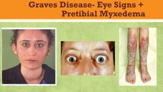 Thyroid Pathologies- Introduction, Benign diseases and Carcinoma ...