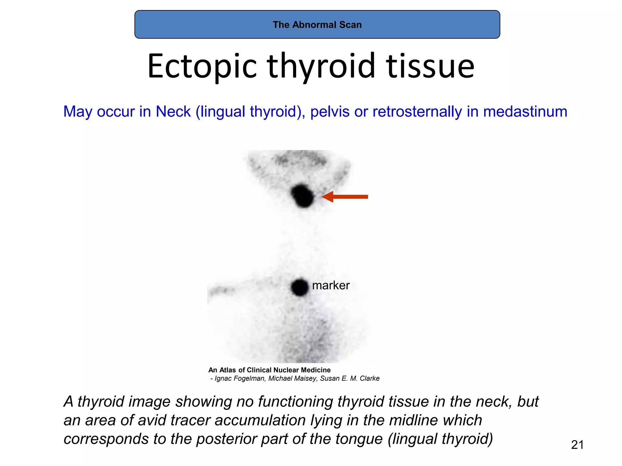 Thyroid pathophysiology scintigraphy[1] | PPTX