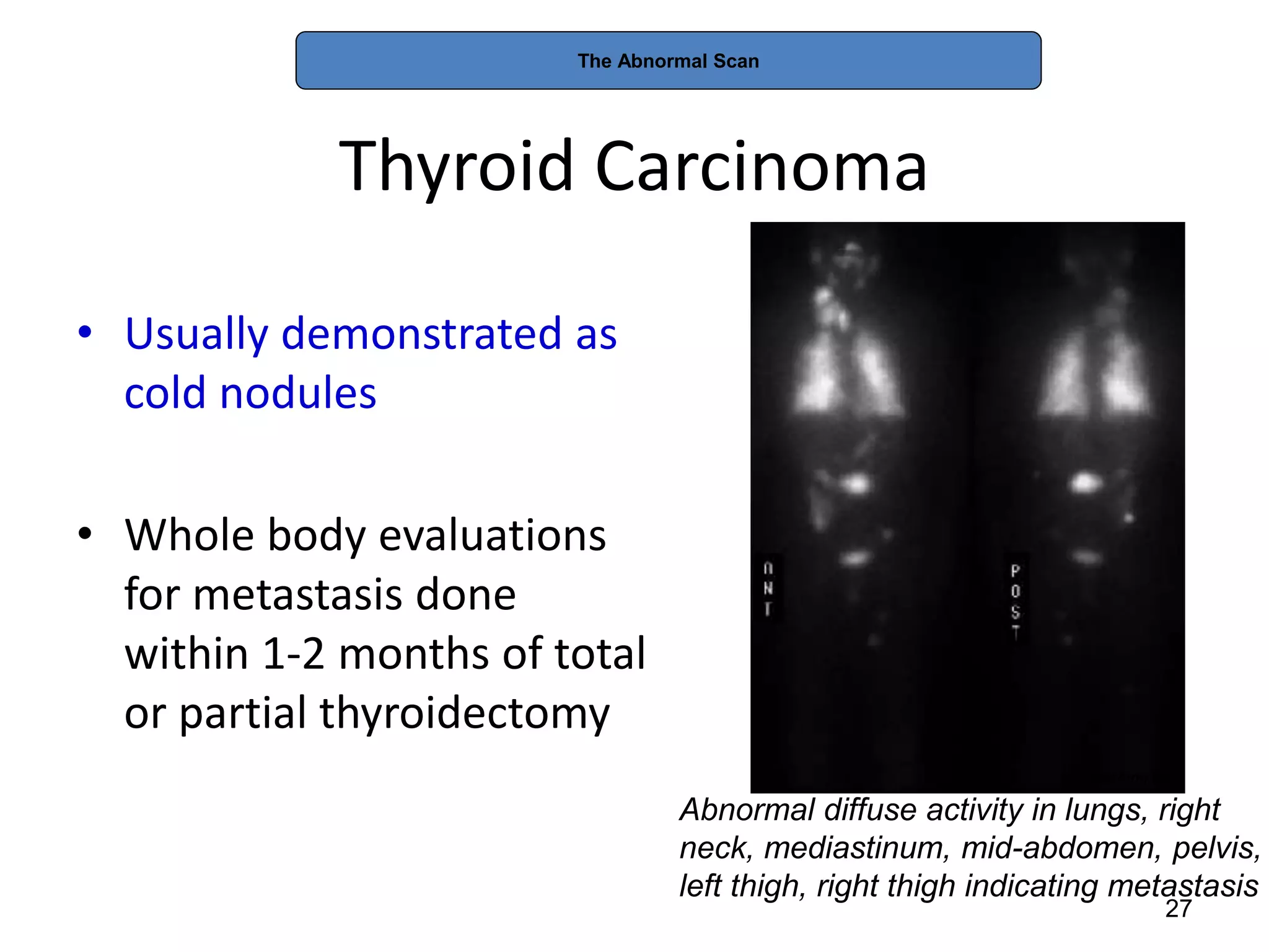 Thyroid pathophysiology scintigraphy[1] | PPTX