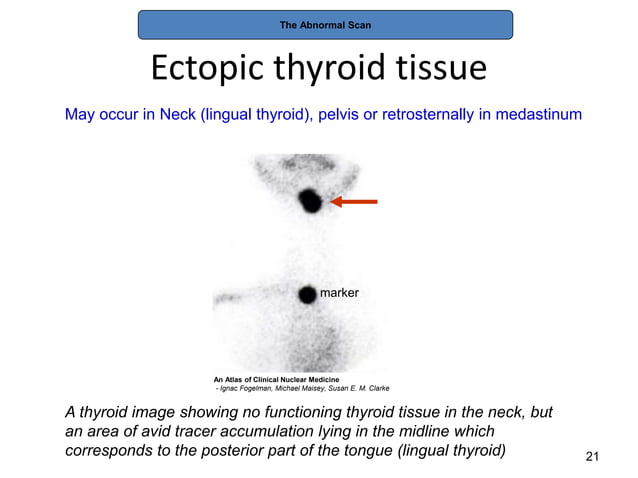 Thyroid pathophysiology scintigraphy[1] | PPTX | Thyroid Disorders ...