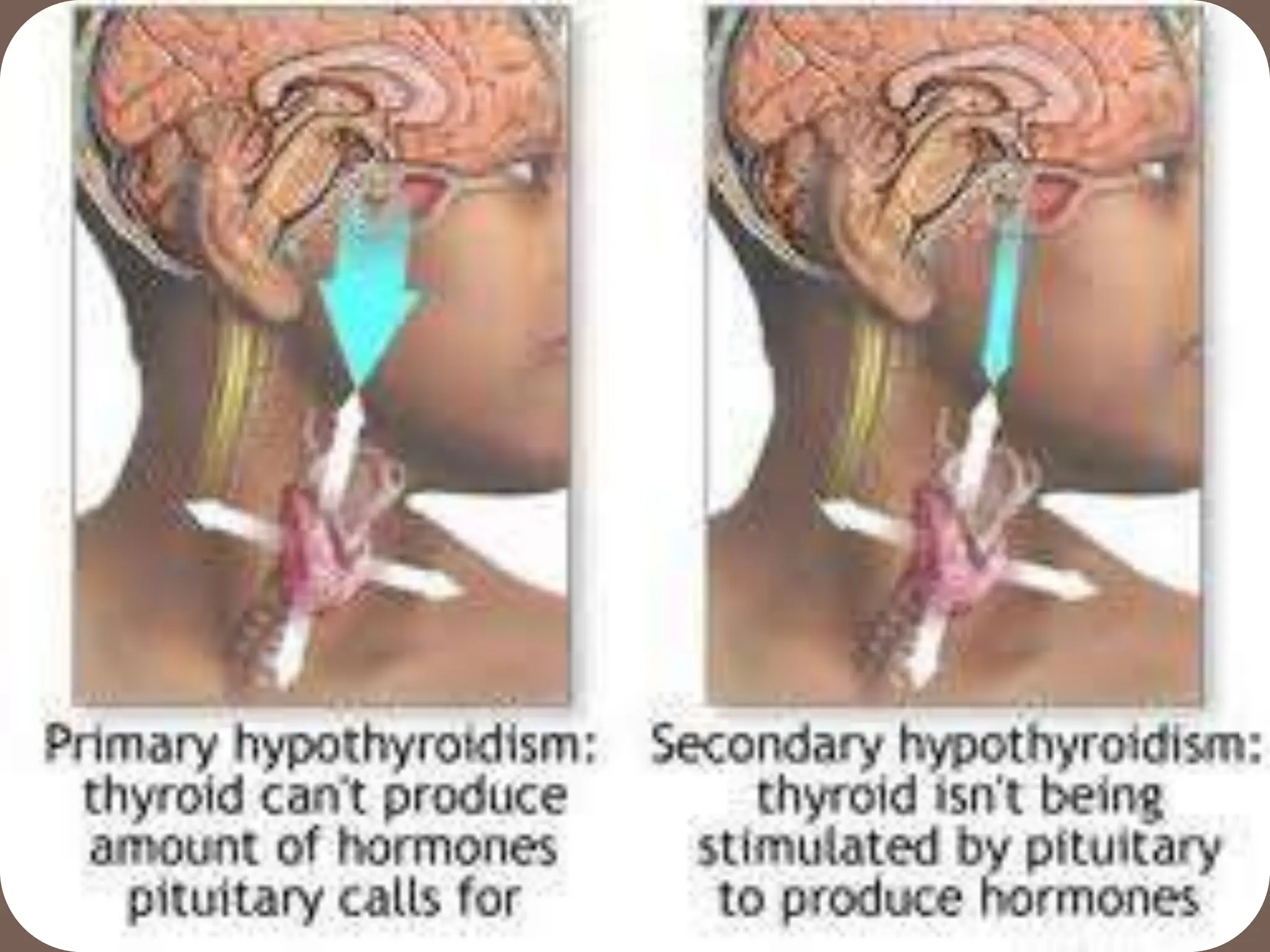 Thyroid Ppt Pptx Ppt