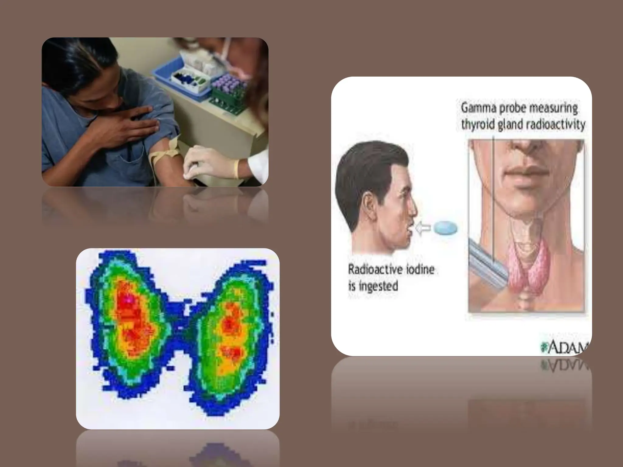 Thyroid Ppt Pptx Ppt
