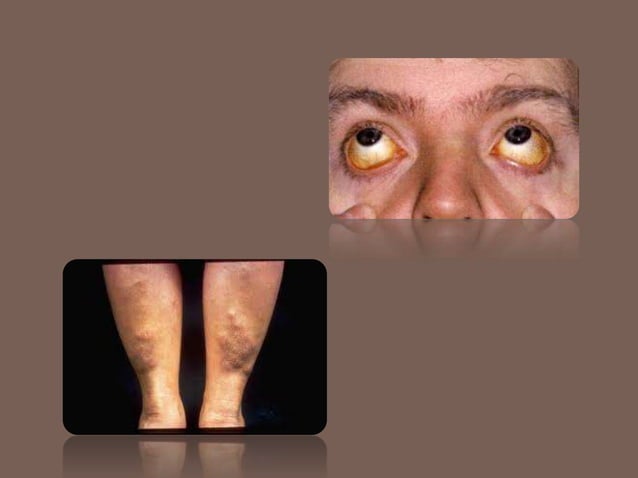 Thyroid Ppt Pptx Ppt