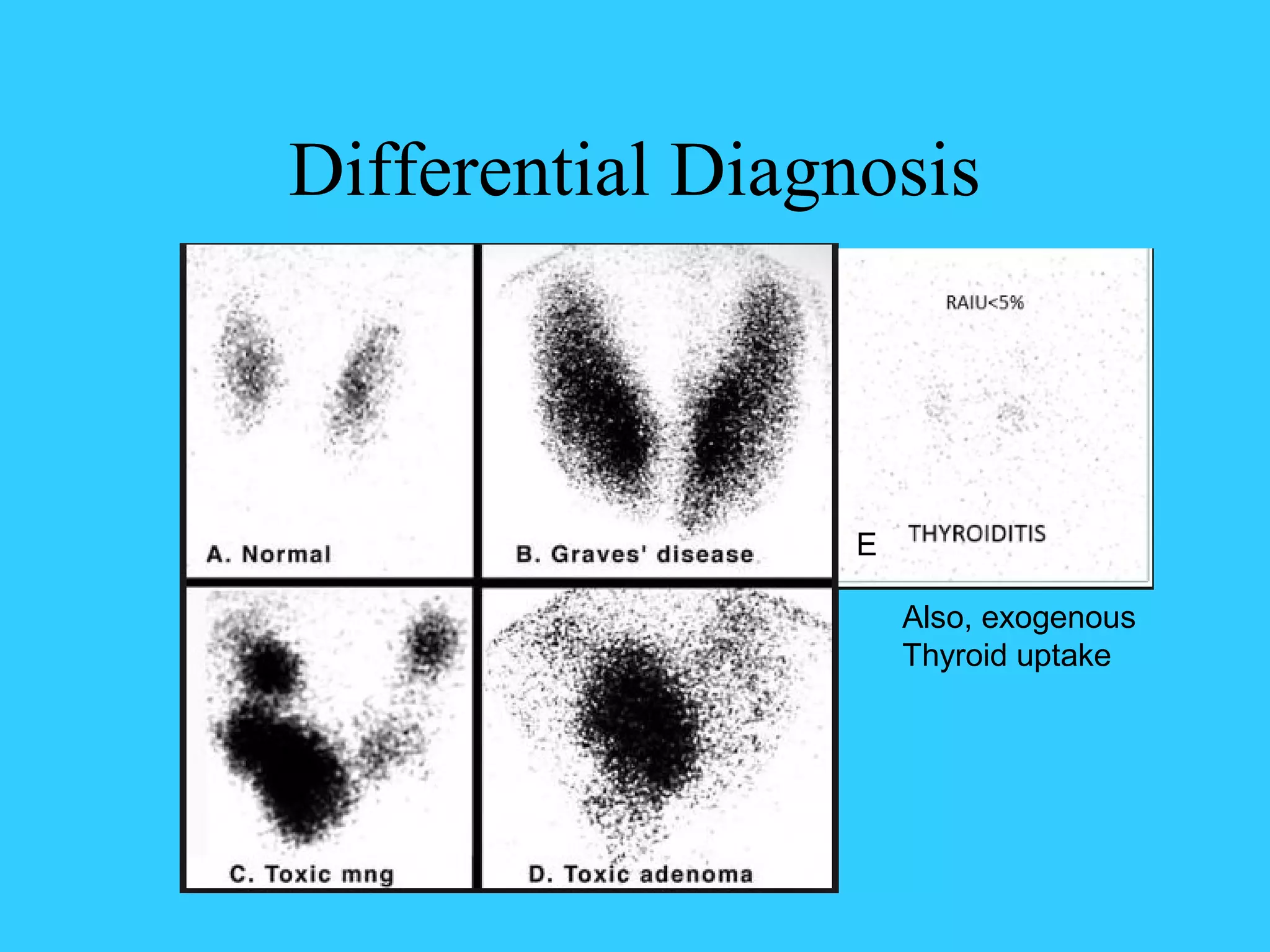 Thyroid resident talk | PPT