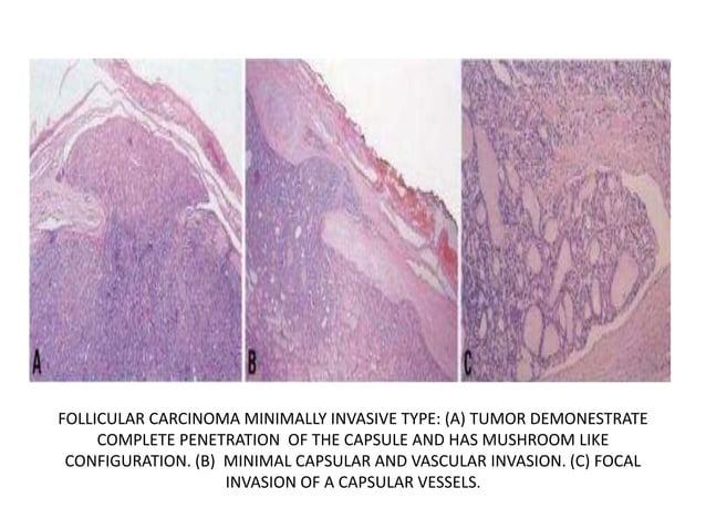 Follicular thyroid differential diagnosis | PPT