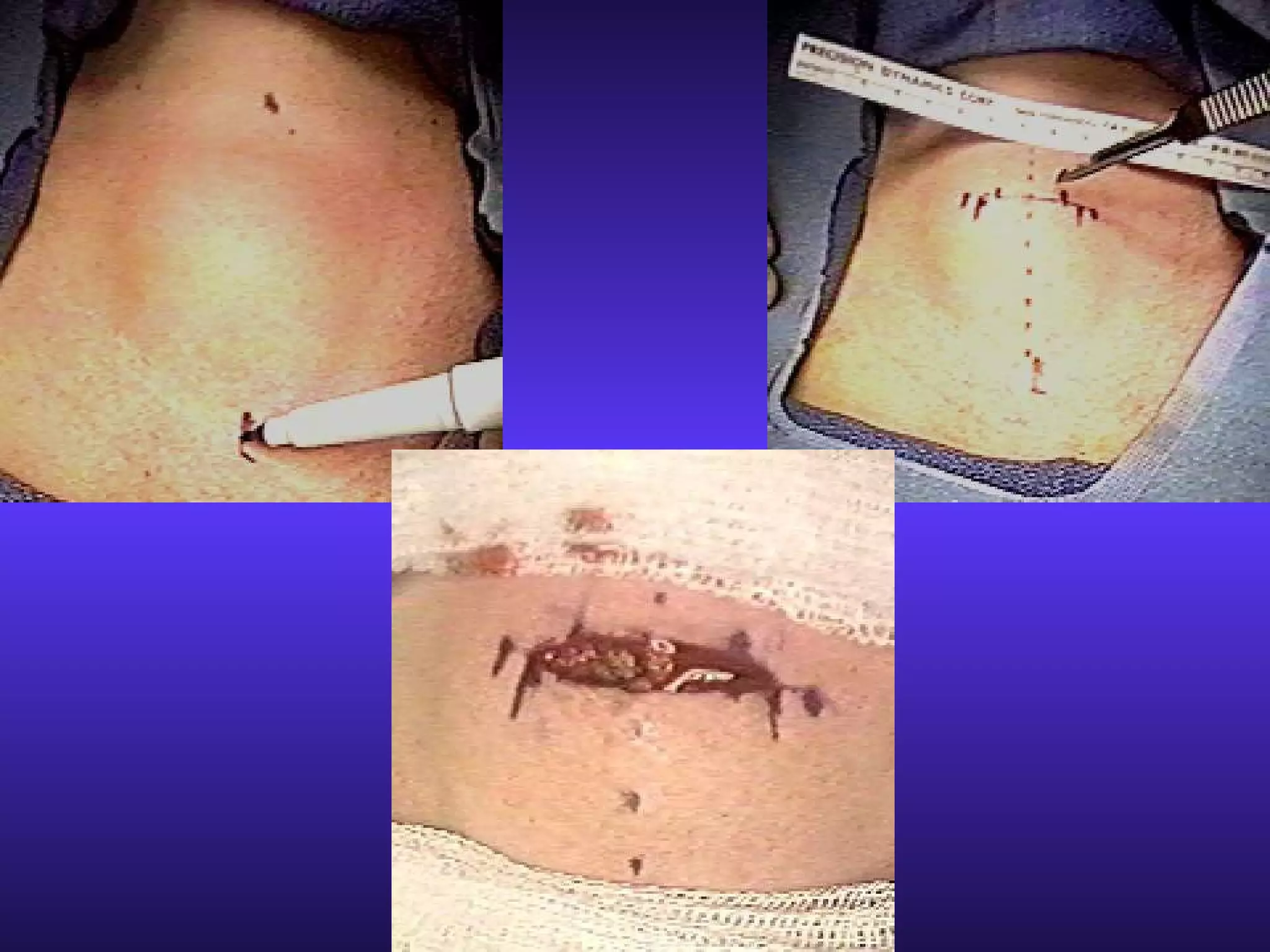 Thyroid Surgery by Mini-incision | PPT