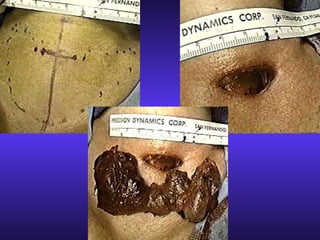 Thyroid Surgery by Mini-incision | PPT