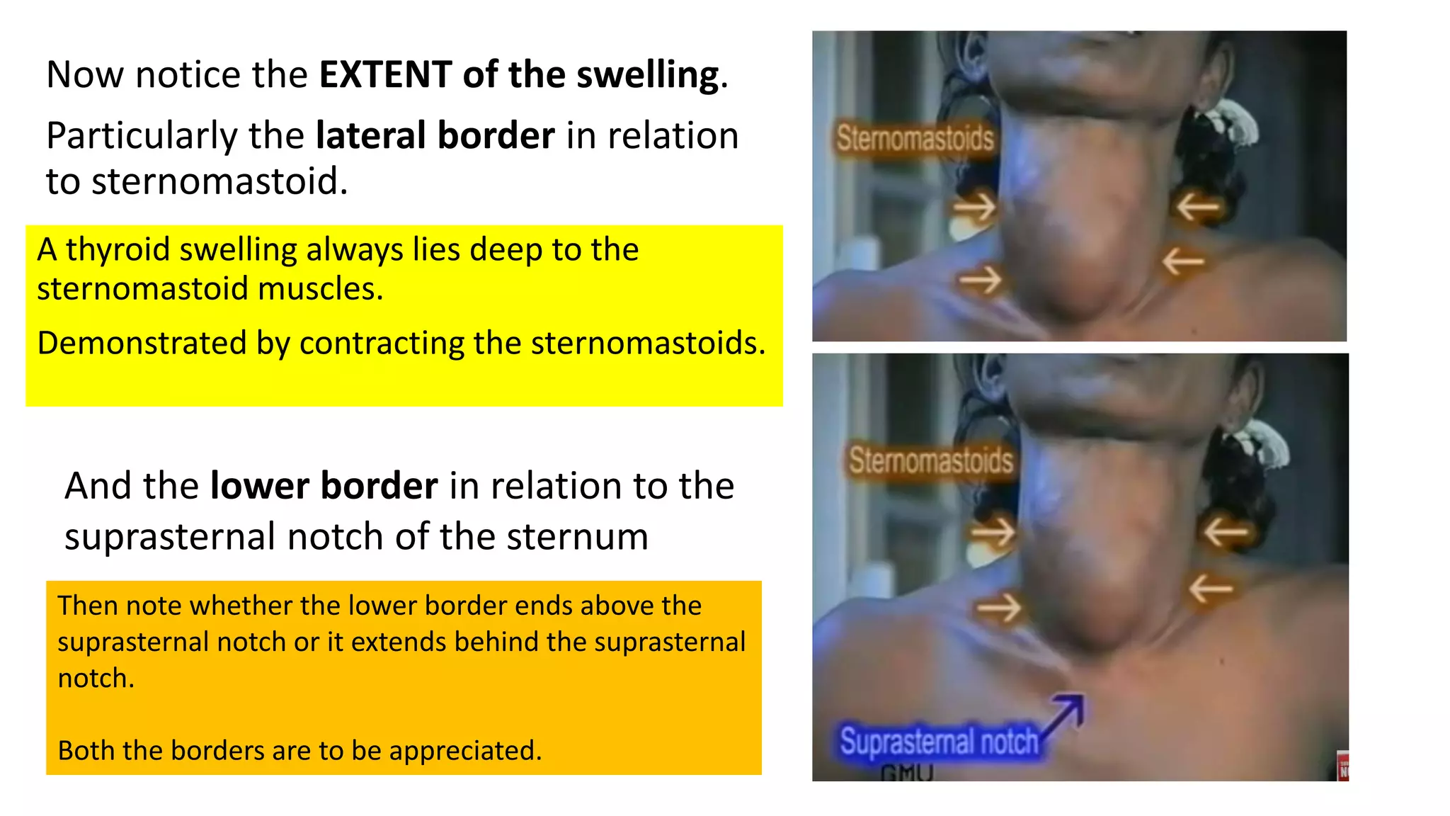 Thyroid Examination - General Surgery | PPTX