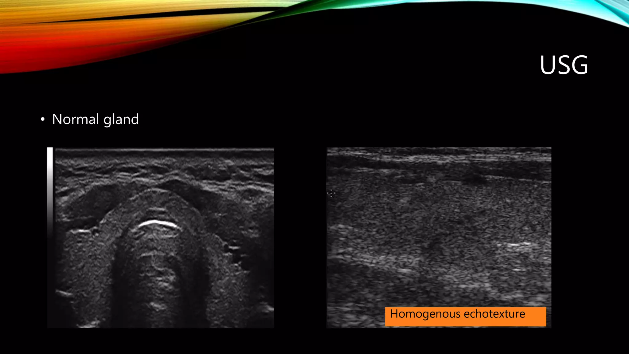 Thyroid swelling and its management | PPTX