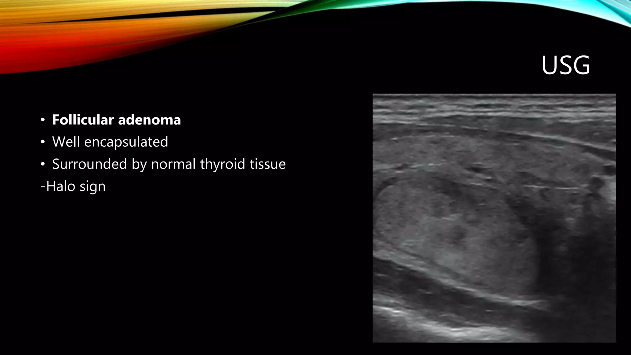 Thyroid swelling and its management | PPTX