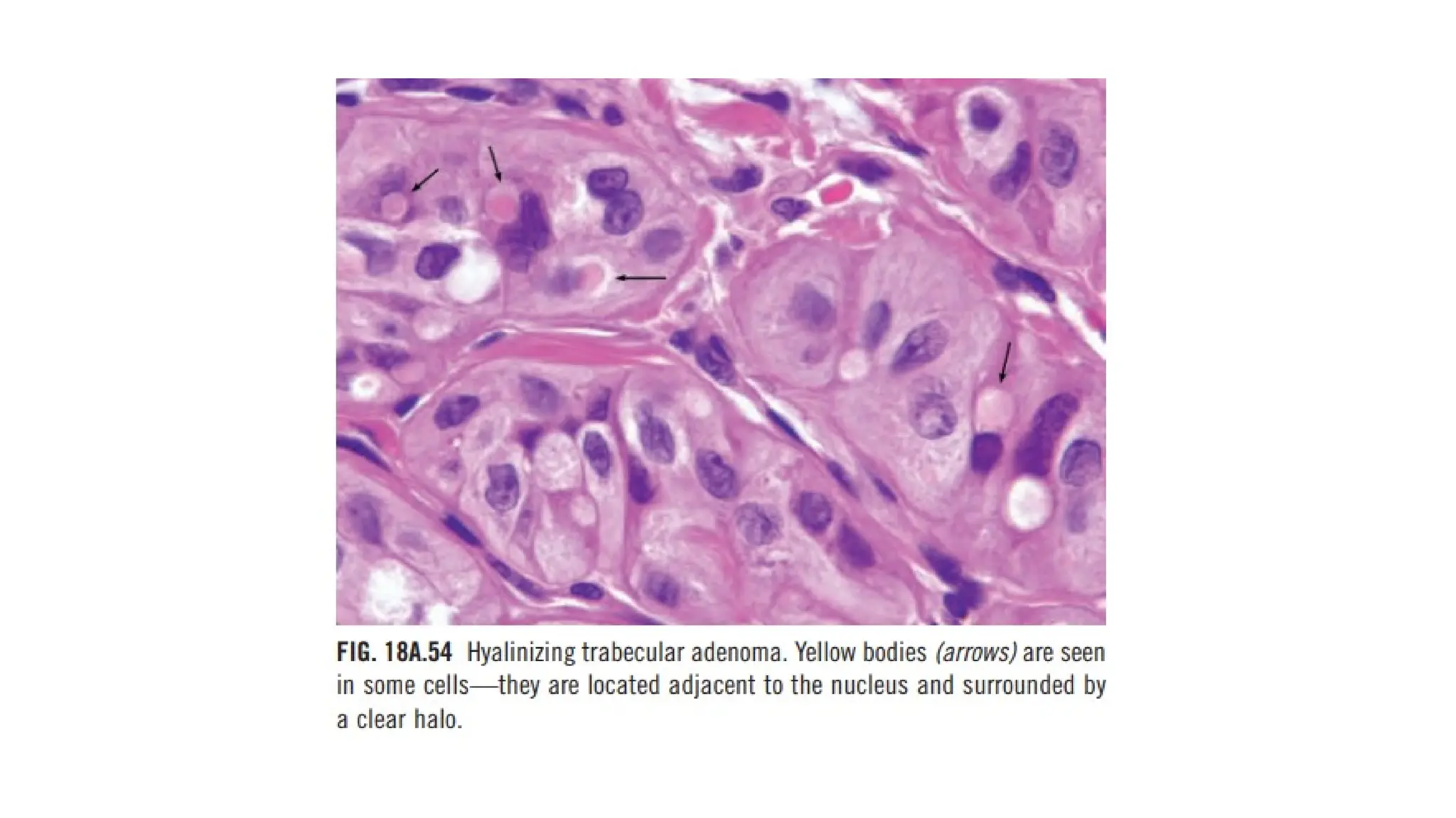Thyroid tumors for pg activity for presentaion.pptx