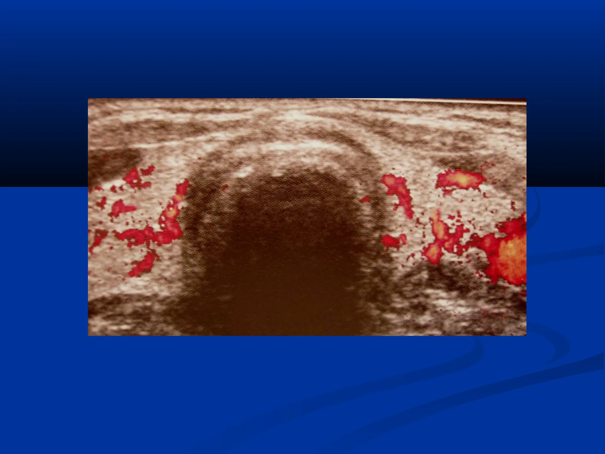 thyroid ultrasound, from basic imaging point of view | PDF