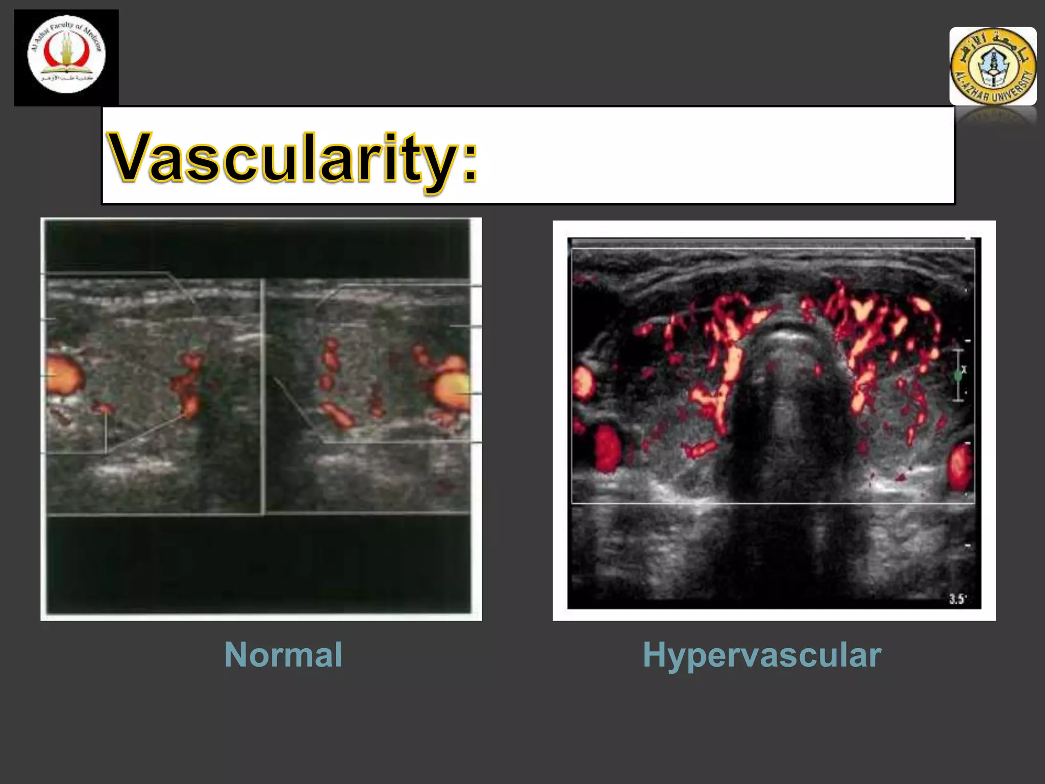 Thyroid us | PPTX