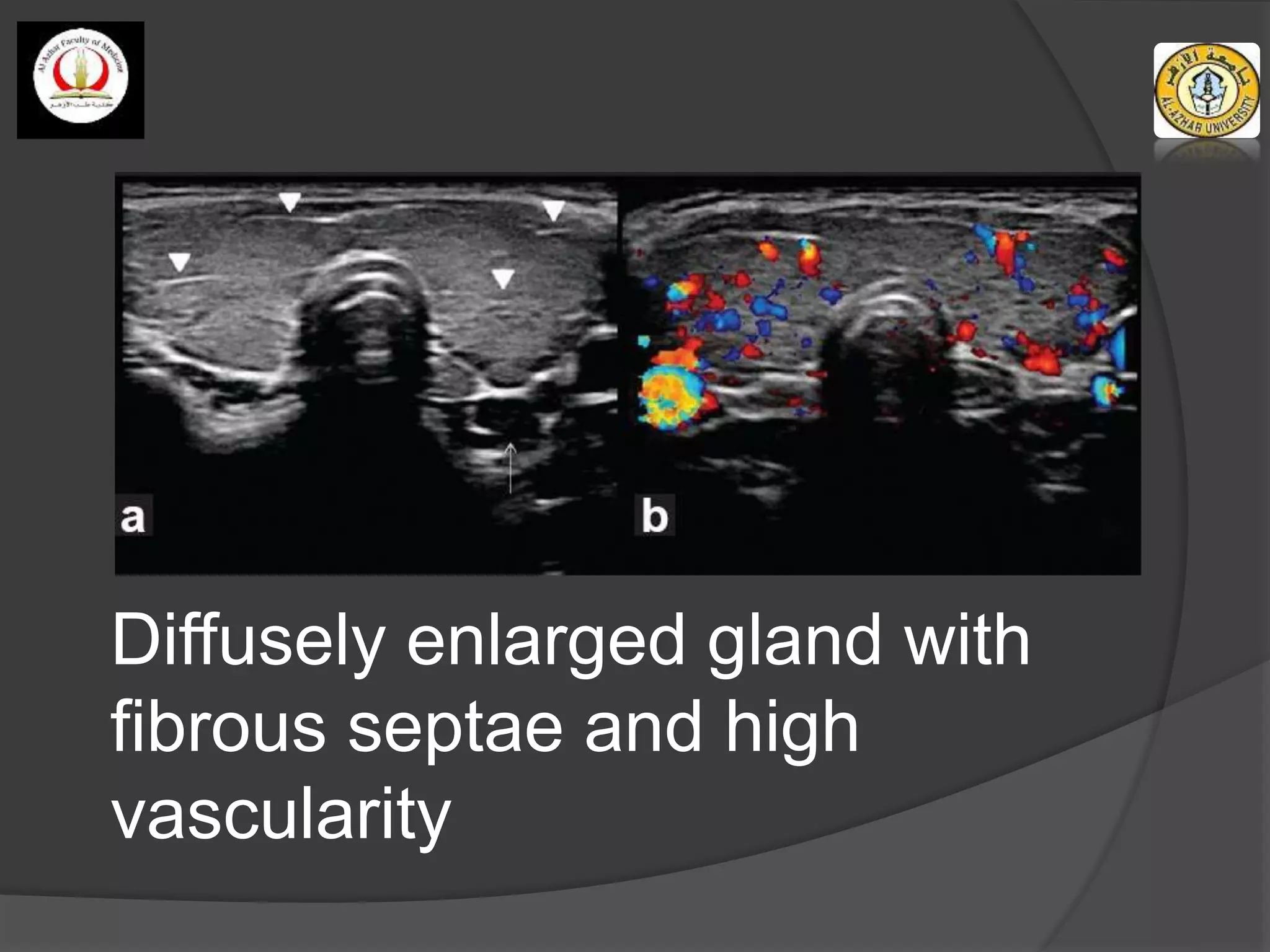 Thyroid us | PPTX