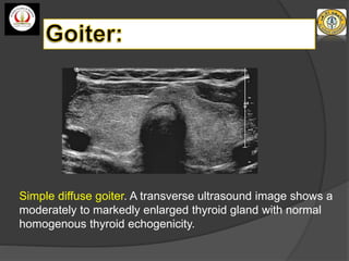 Thyroid us | PPTX