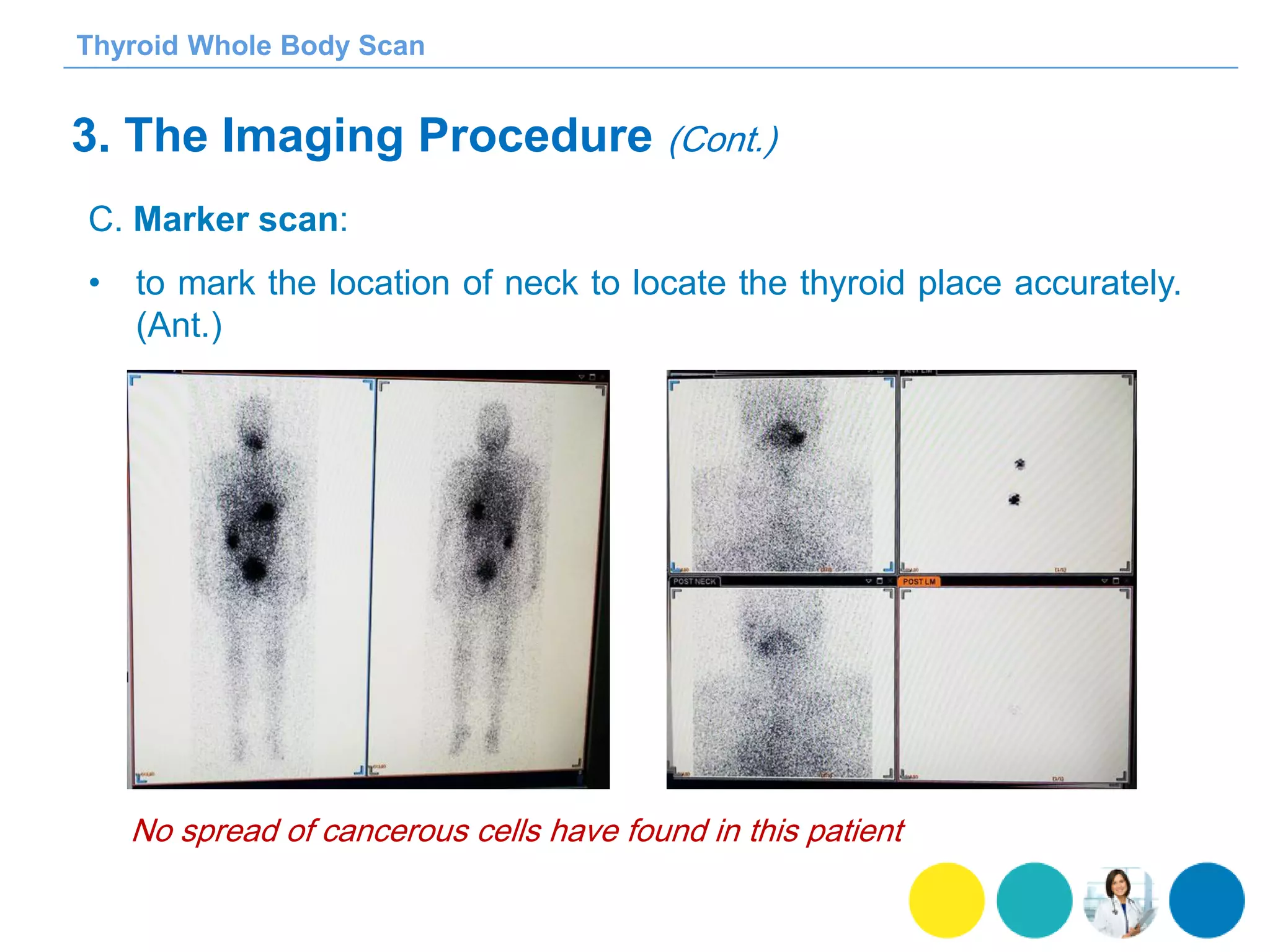 Thyroid whole body scan | PDF