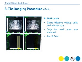 Thyroid whole body scan | PDF