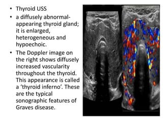 Thyrotoxicosis | PPTX