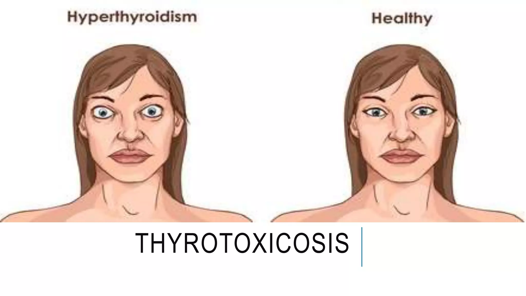 Thyrotoxicosis | PPTX