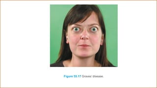 thyrotoxicosis in surgical view, thyroid surgery, including techniques ...