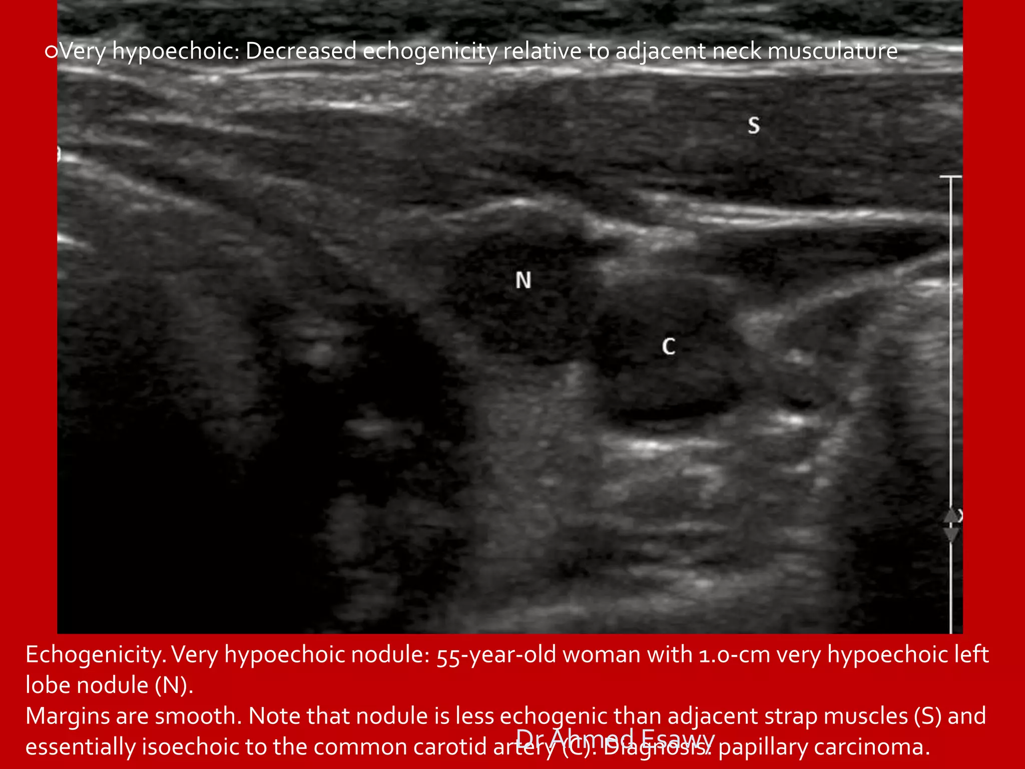 TIRADS (thyroid nodule imaging reporting and data system) Dr Ahmed ...