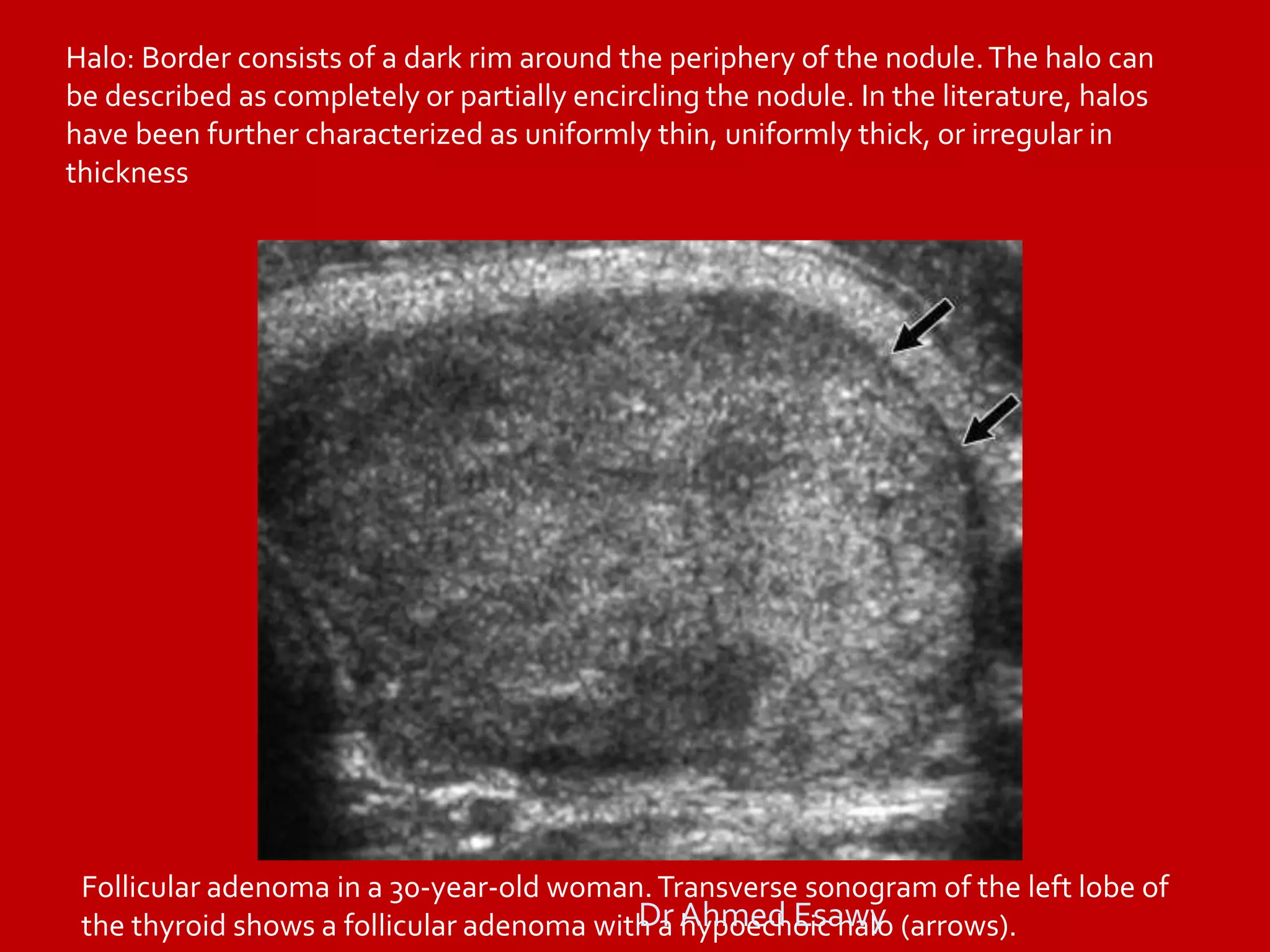 TIRADS (thyroid nodule imaging reporting and data system) Dr Ahmed ...