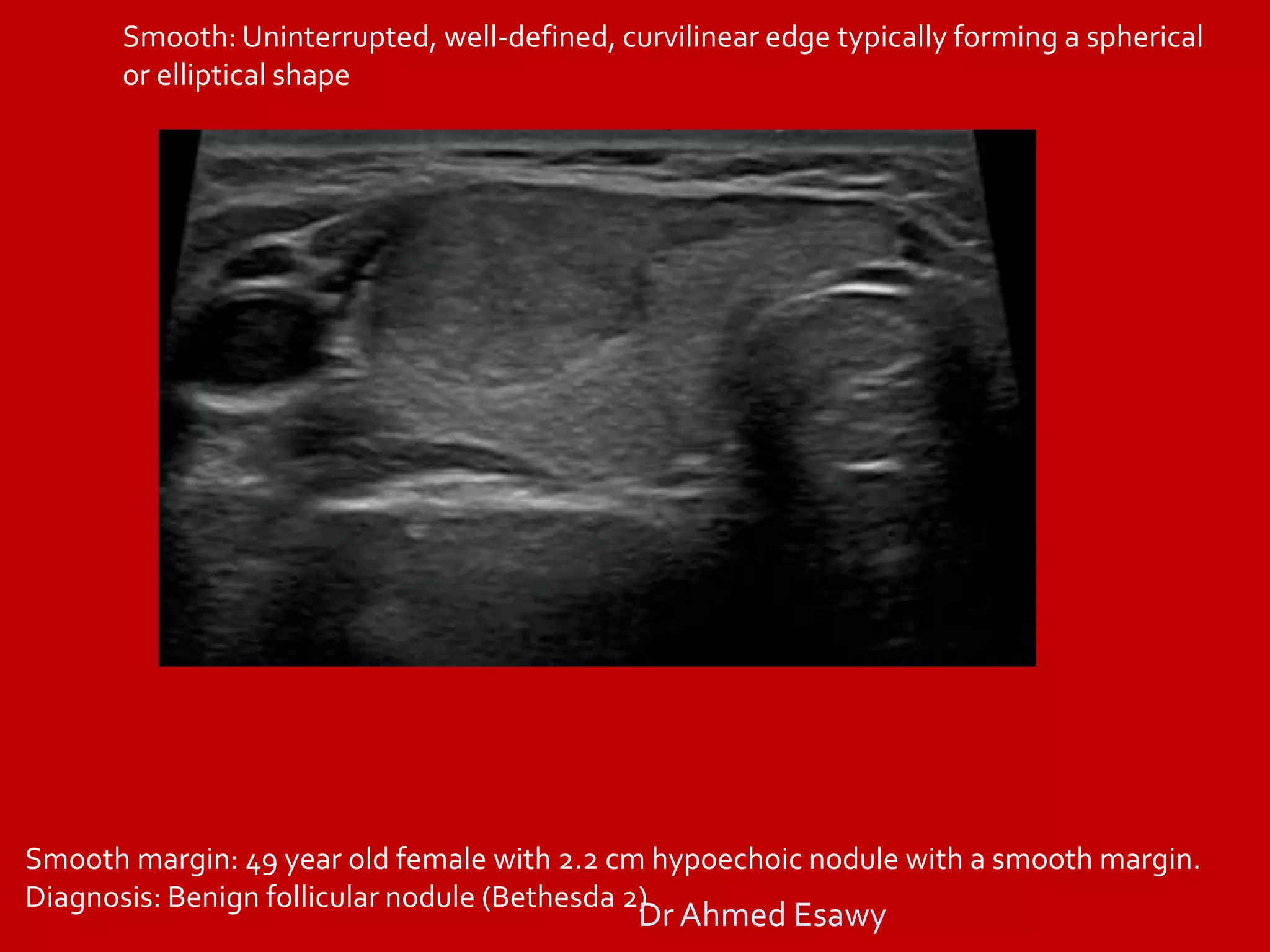 TIRADS (thyroid nodule imaging reporting and data system) Dr Ahmed ...