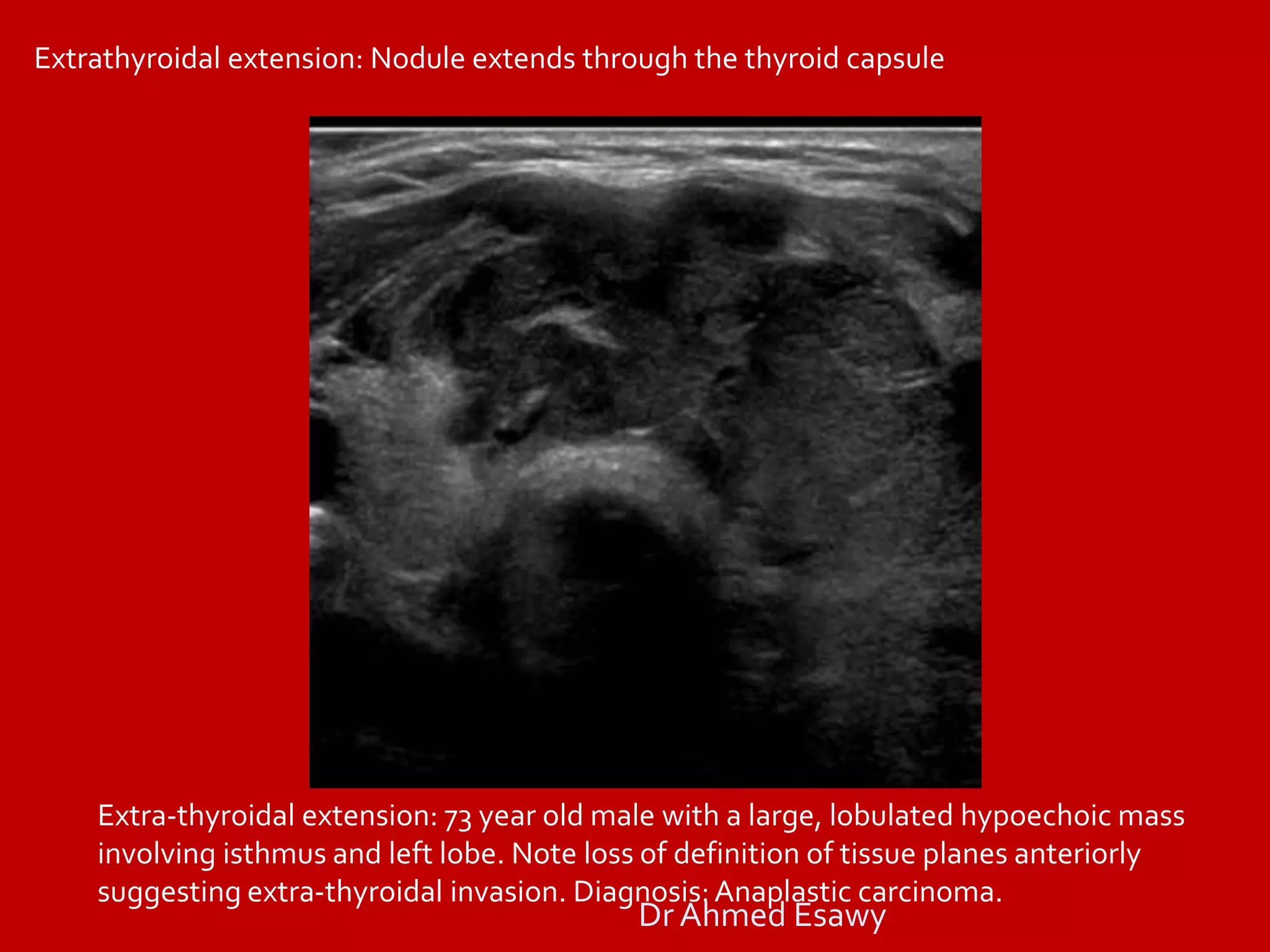 TIRADS (thyroid nodule imaging reporting and data system) Dr Ahmed ...