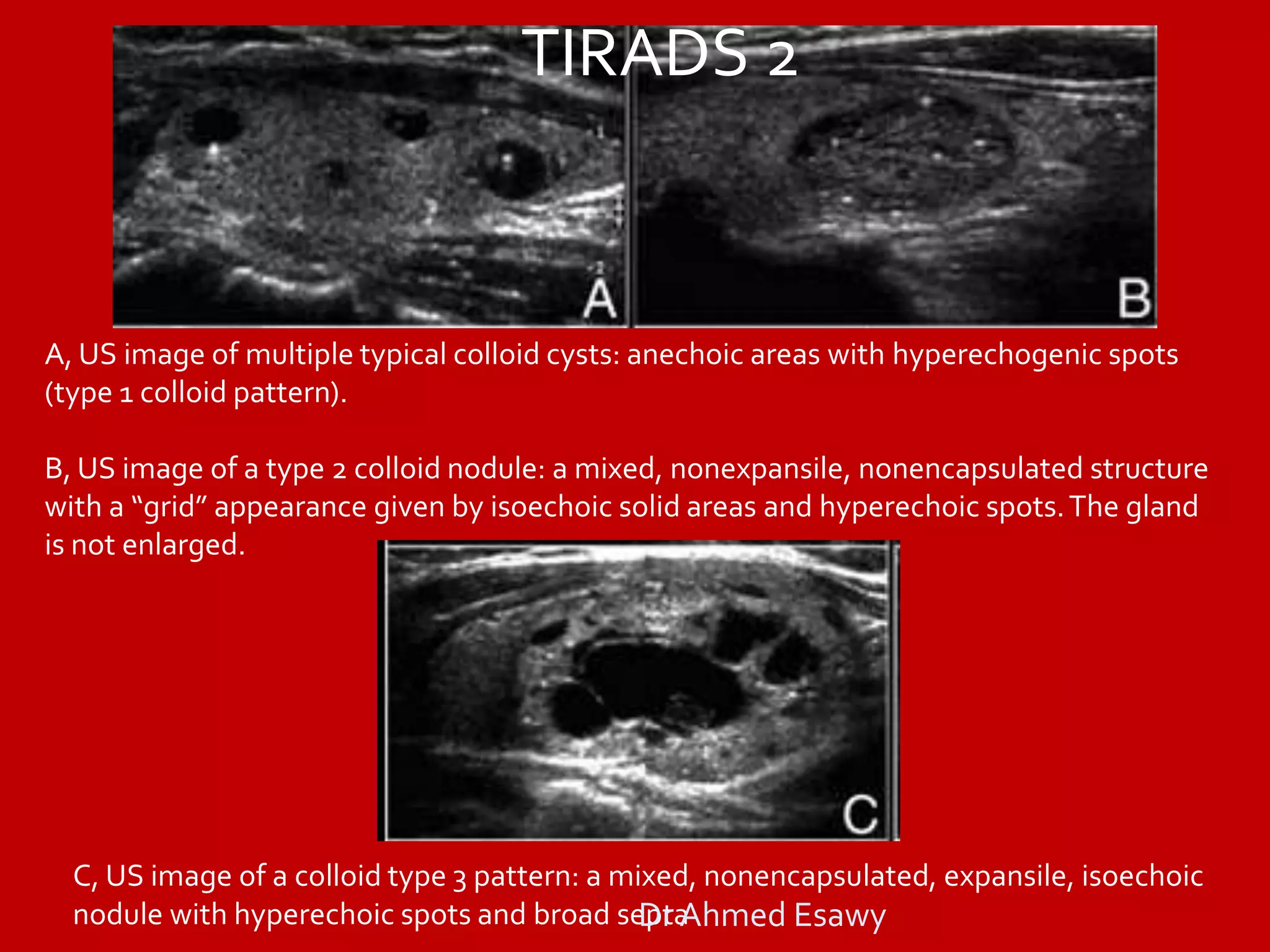 TIRADS (thyroid nodule imaging reporting and data system) Dr Ahmed ...
