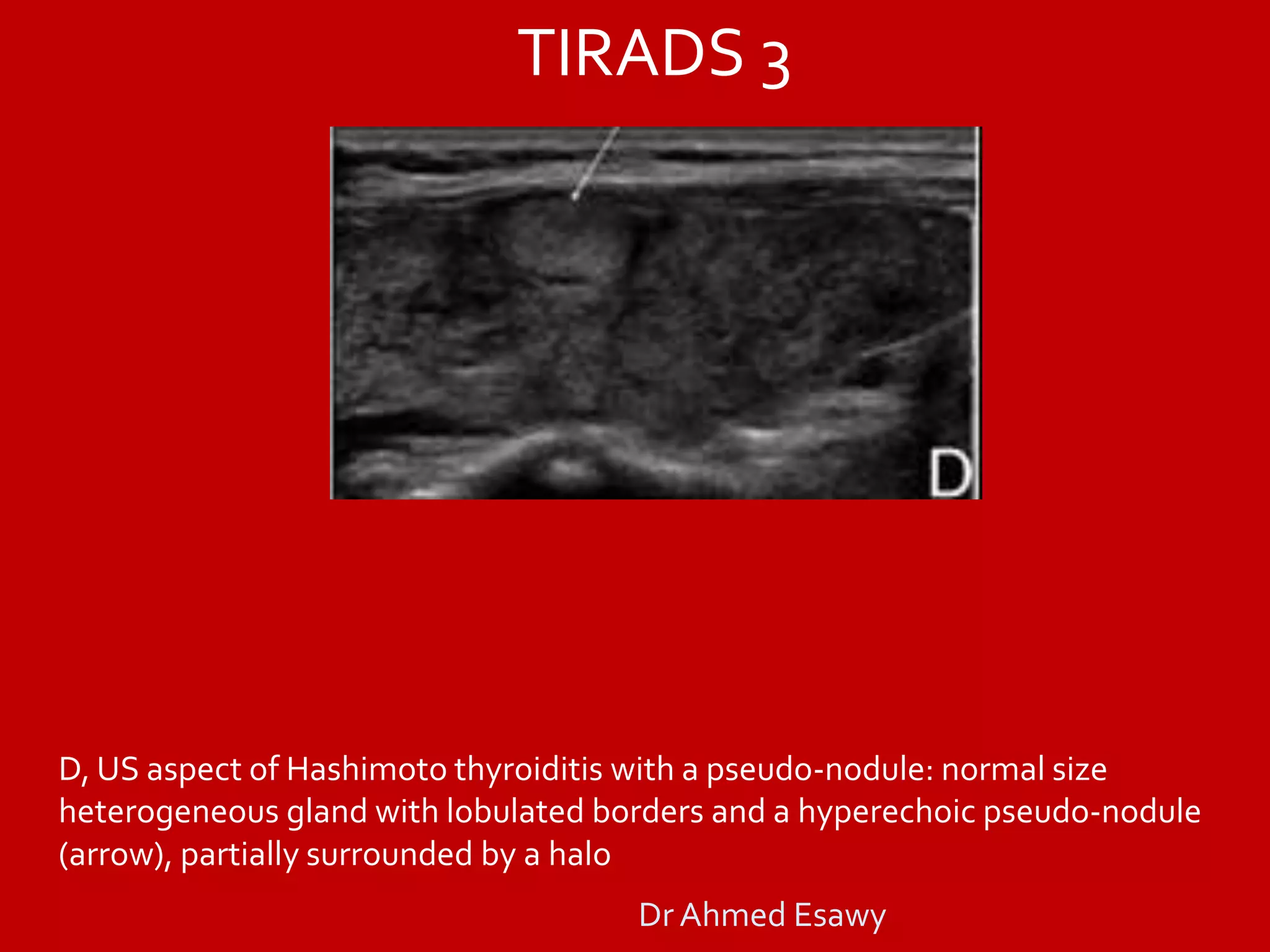 TIRADS (thyroid nodule imaging reporting and data system) Dr Ahmed ...
