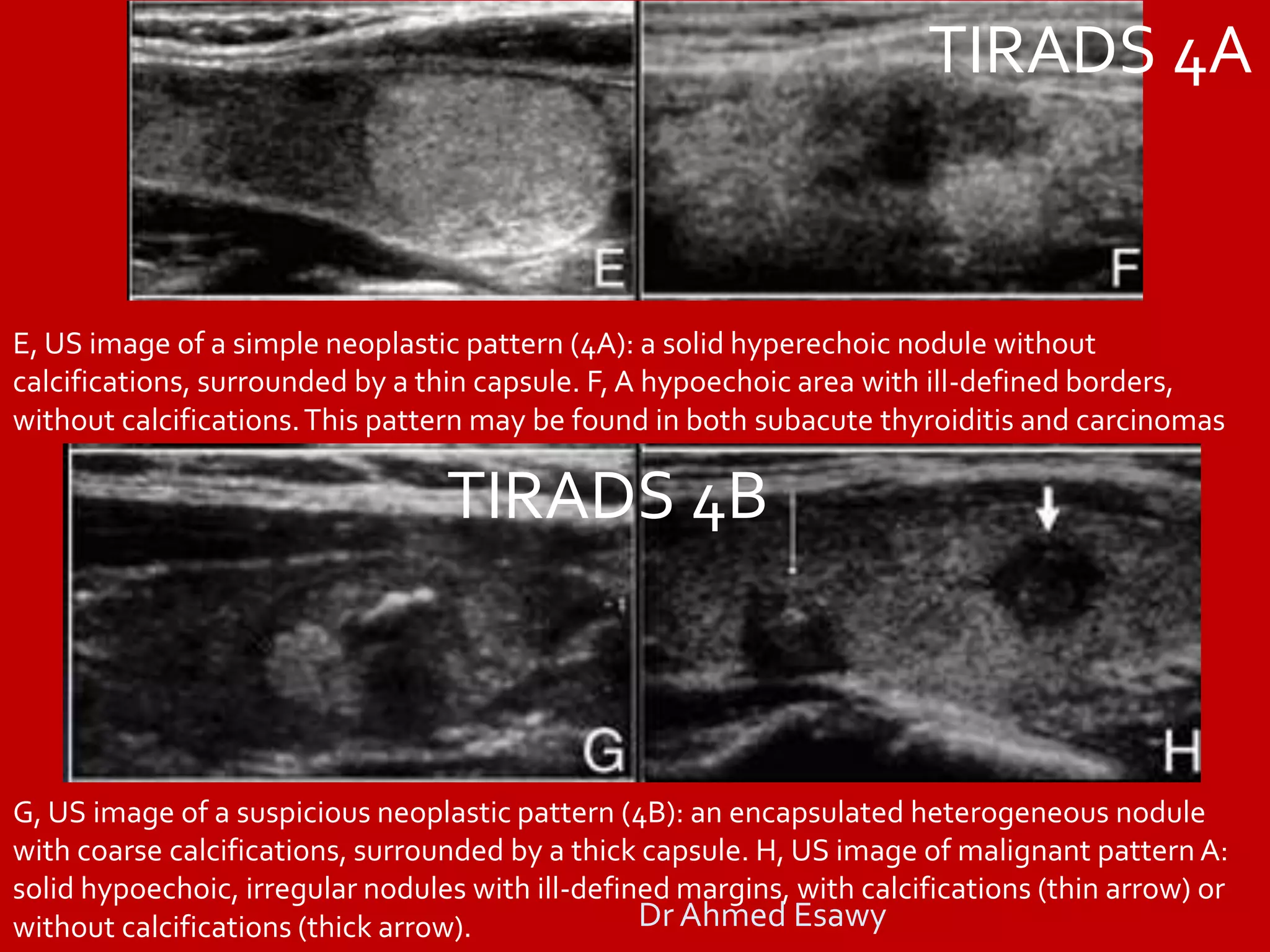 TIRADS (thyroid nodule imaging reporting and data system) Dr Ahmed ...