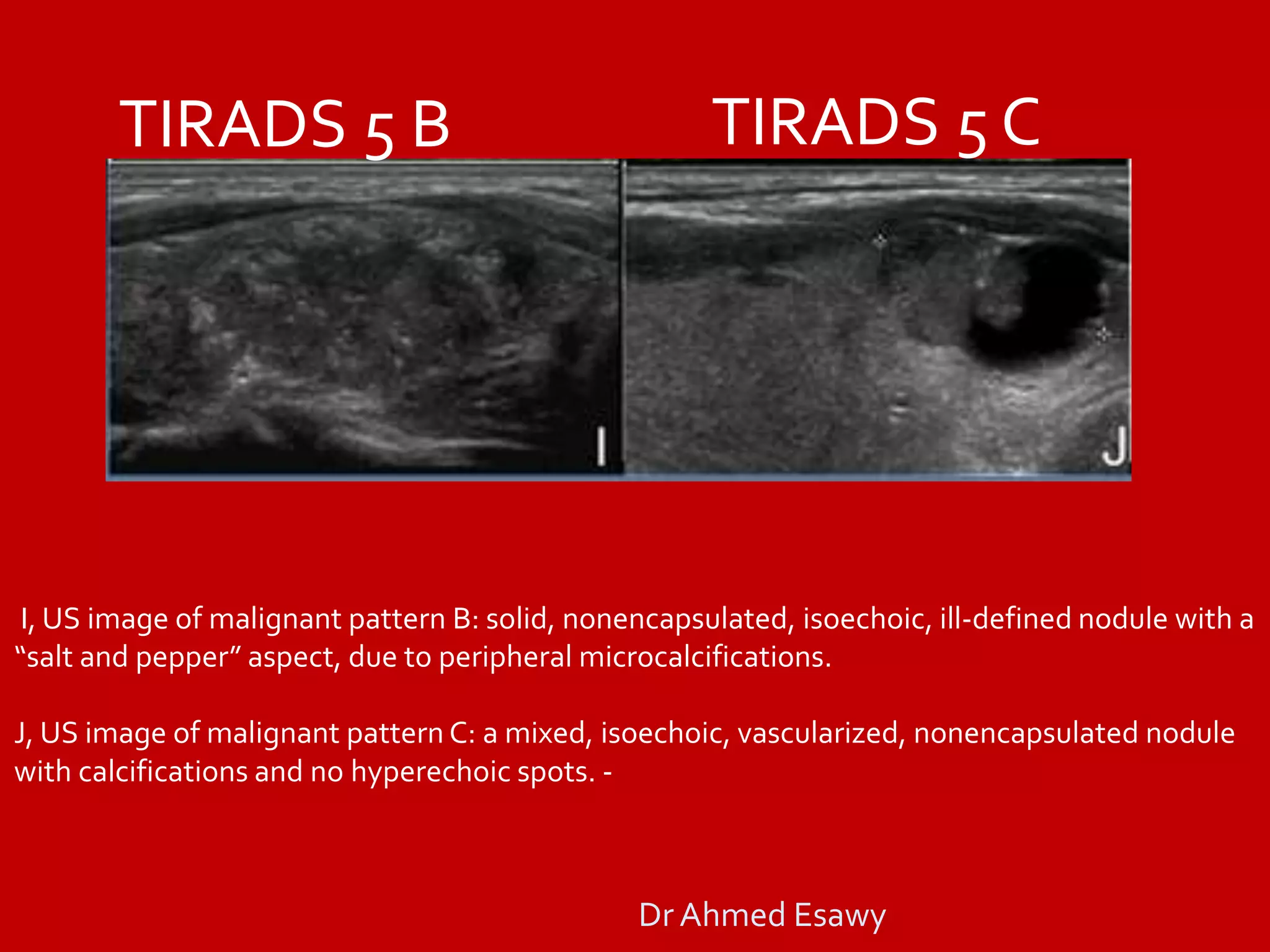 TIRADS (thyroid nodule imaging reporting and data system) Dr Ahmed ...