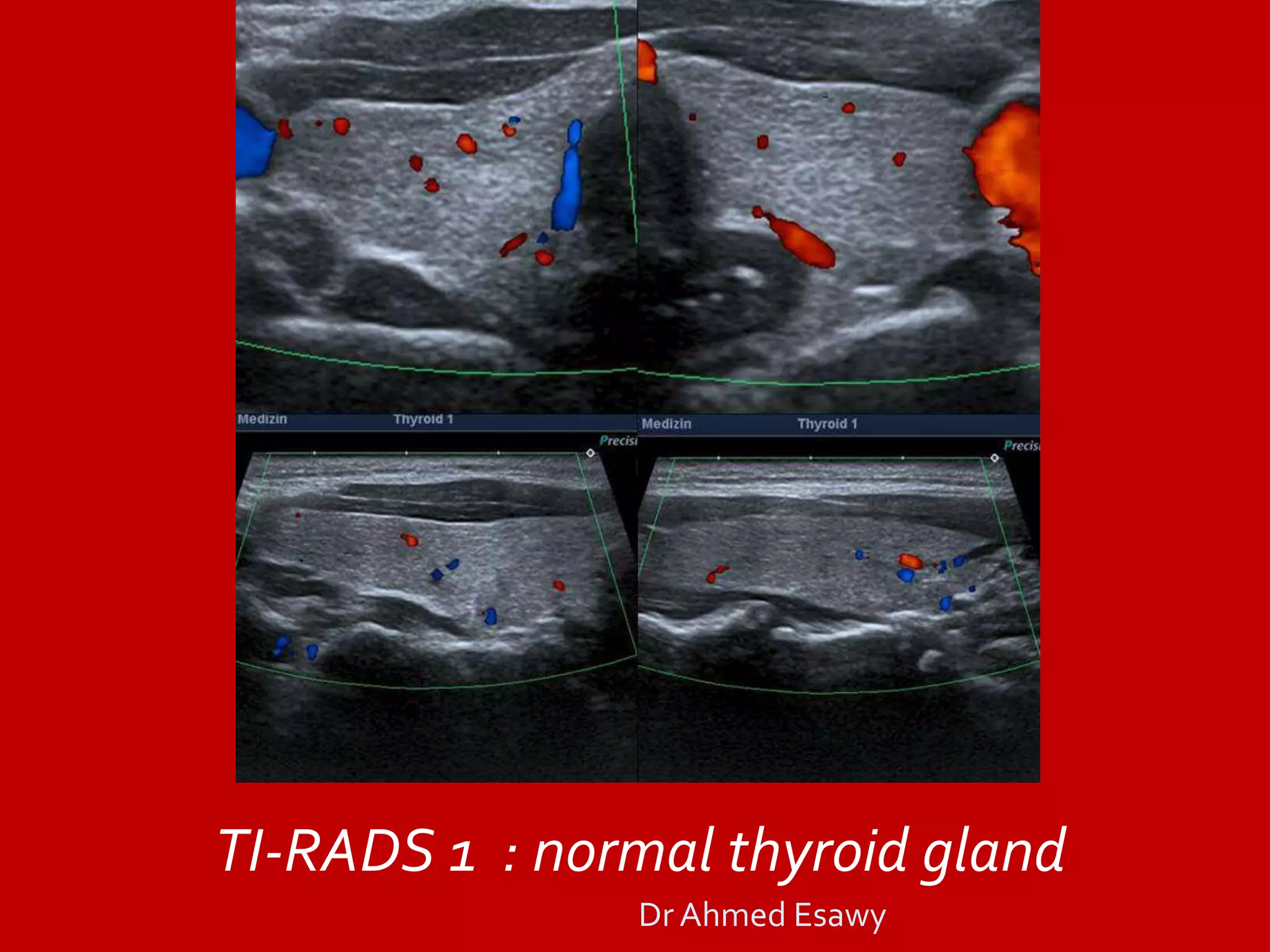 TIRADS (thyroid nodule imaging reporting and data system) Dr Ahmed ...