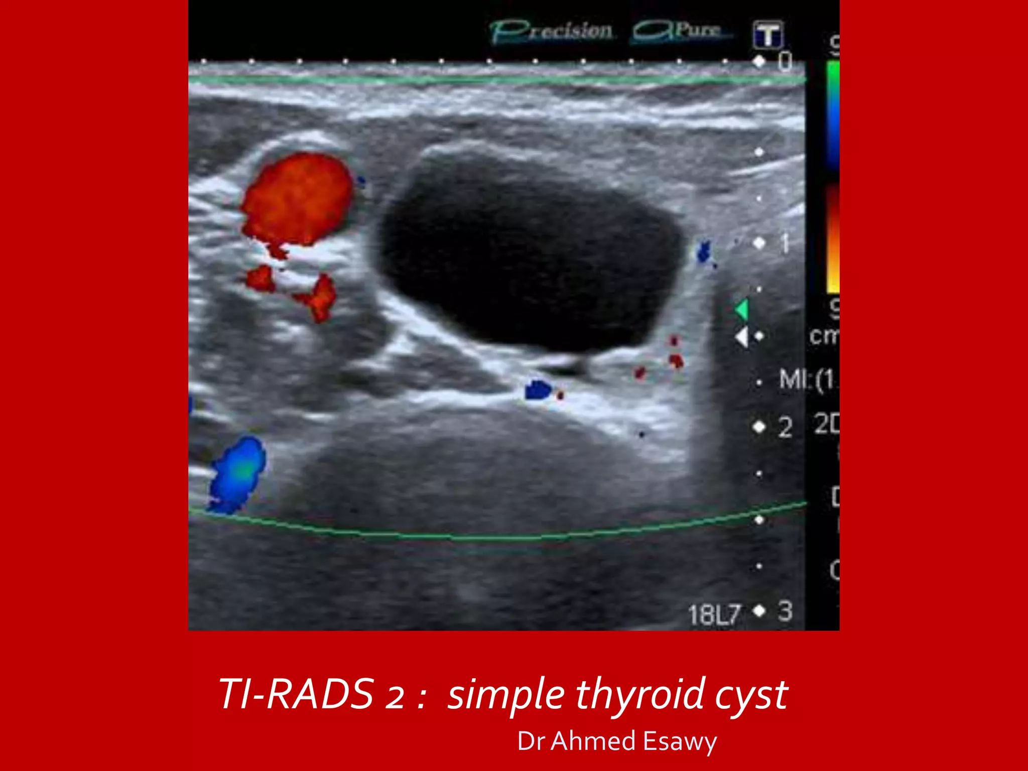 TIRADS (thyroid nodule imaging reporting and data system) Dr Ahmed ...