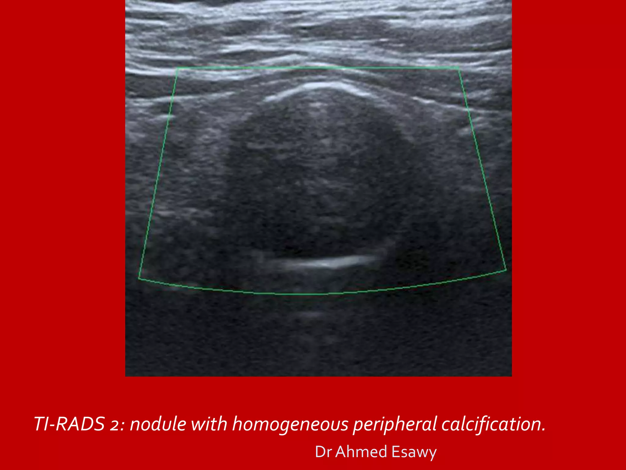 TIRADS (thyroid nodule imaging reporting and data system) Dr Ahmed ...