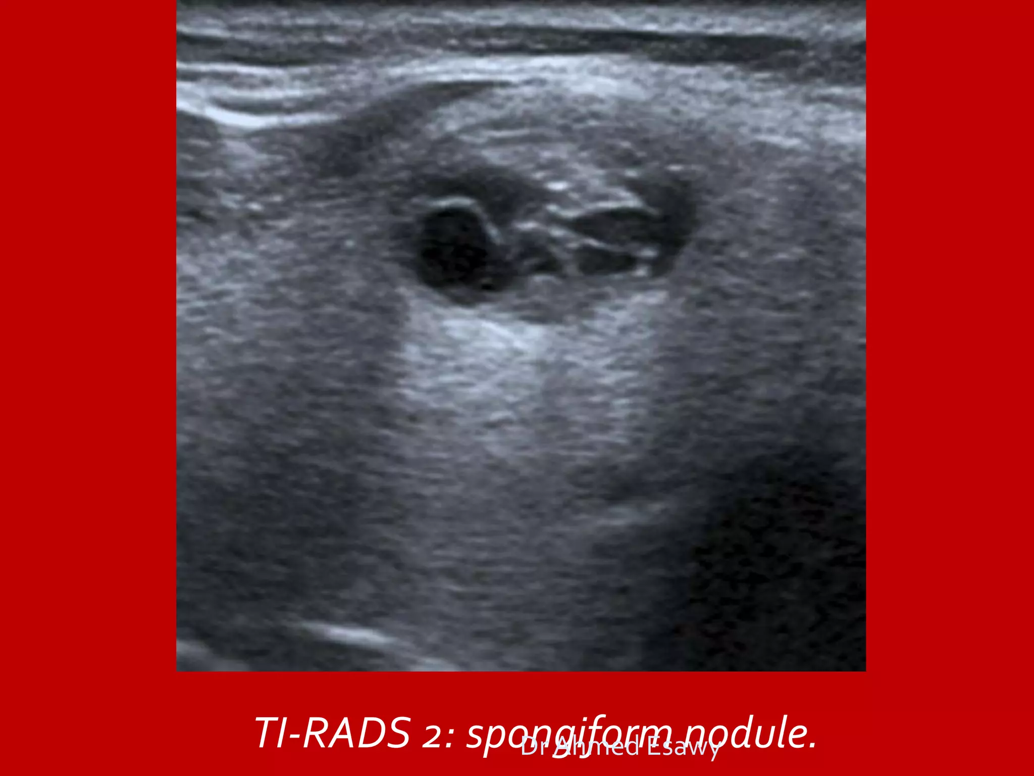 TIRADS (thyroid nodule imaging reporting and data system) Dr Ahmed ...