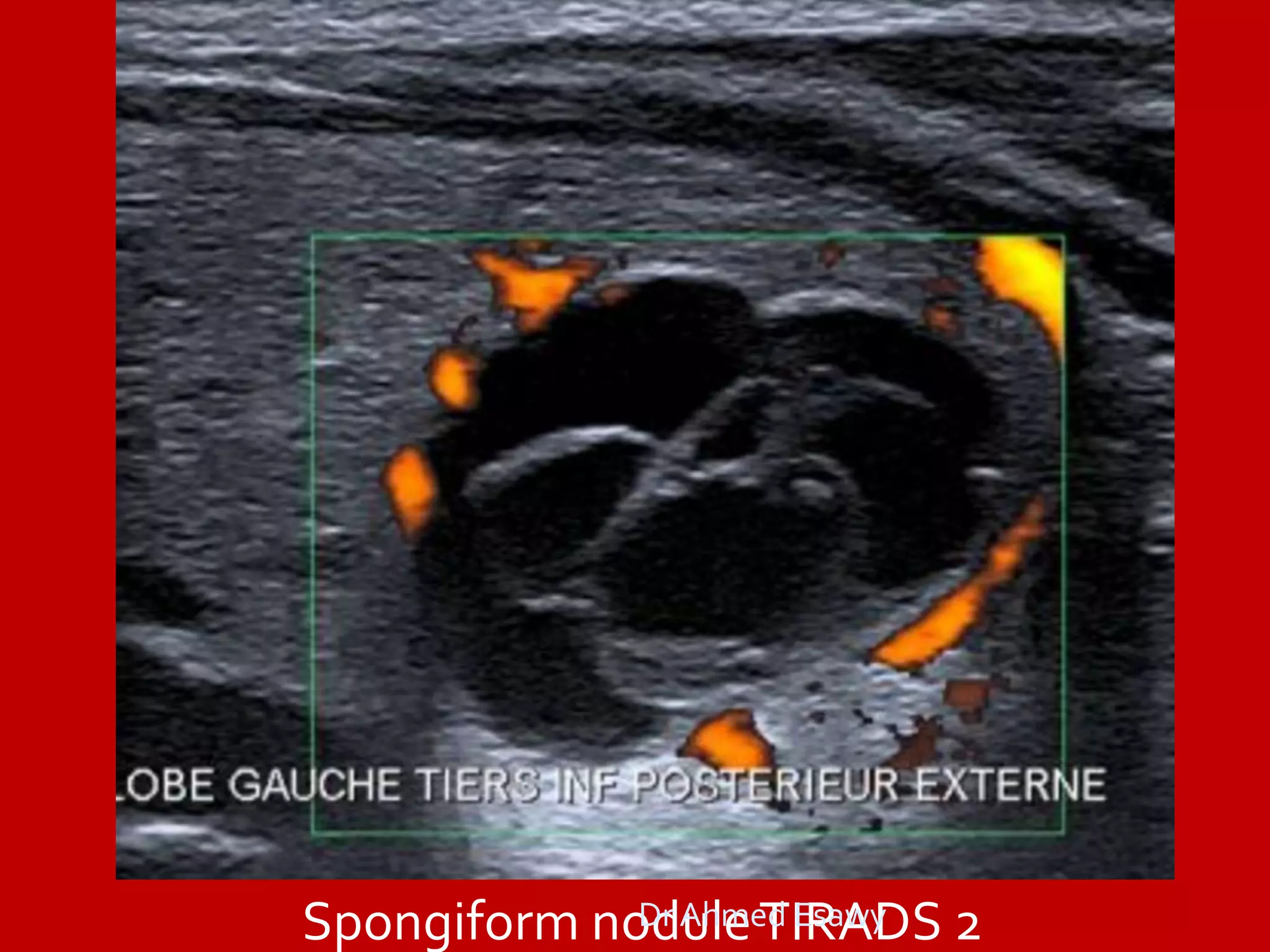 TIRADS (thyroid nodule imaging reporting and data system) Dr Ahmed ...