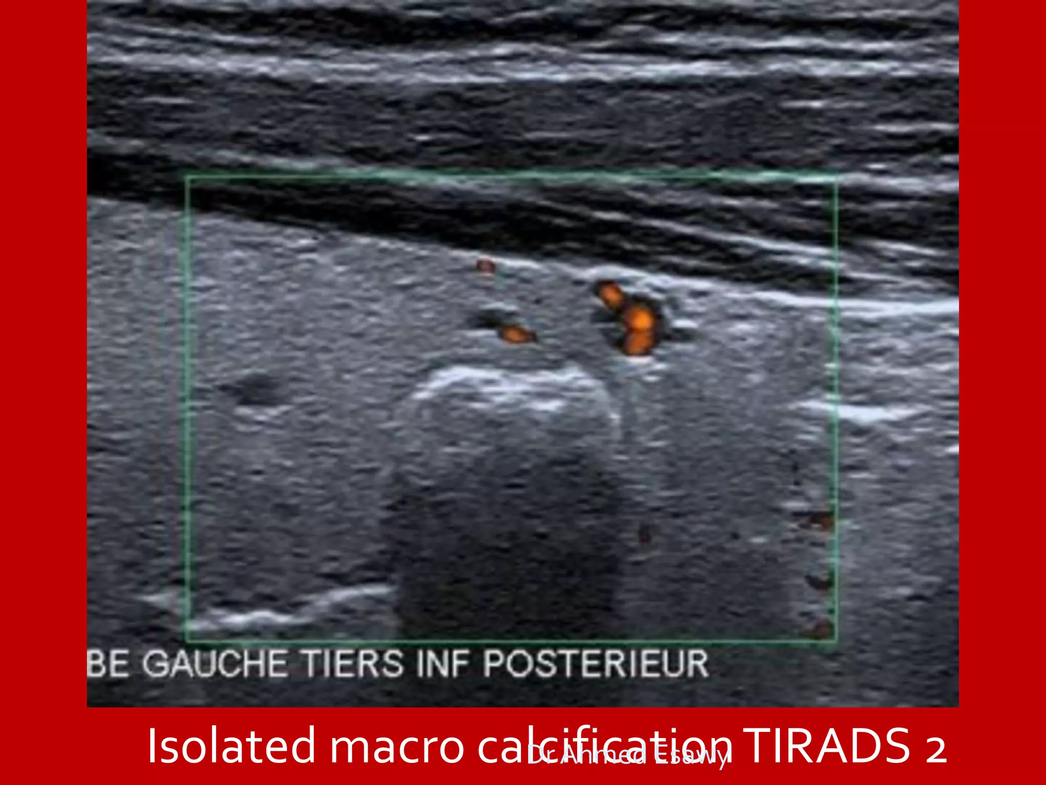 TIRADS (thyroid nodule imaging reporting and data system) Dr Ahmed ...