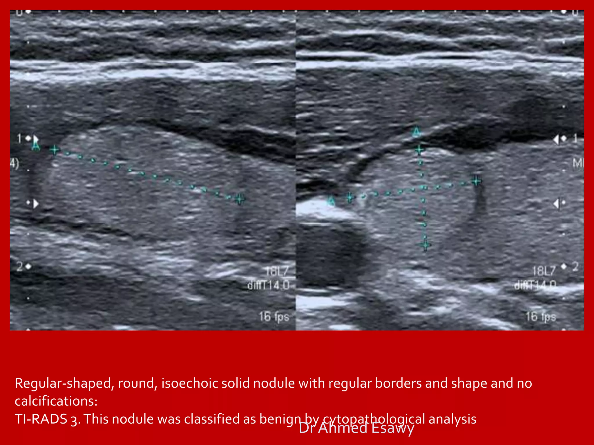 TIRADS (thyroid nodule imaging reporting and data system) Dr Ahmed ...