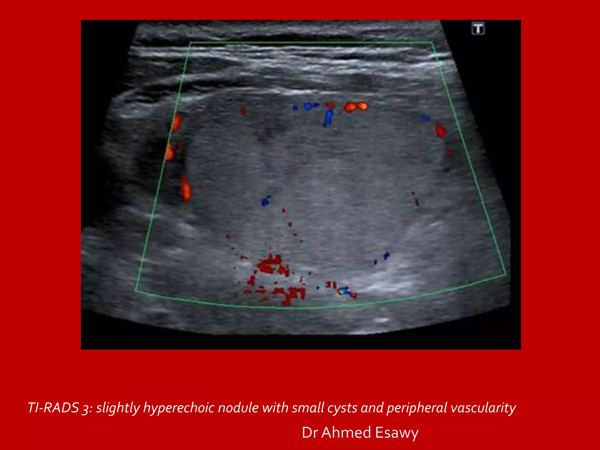 TIRADS (thyroid nodule imaging reporting and data system) Dr Ahmed ...