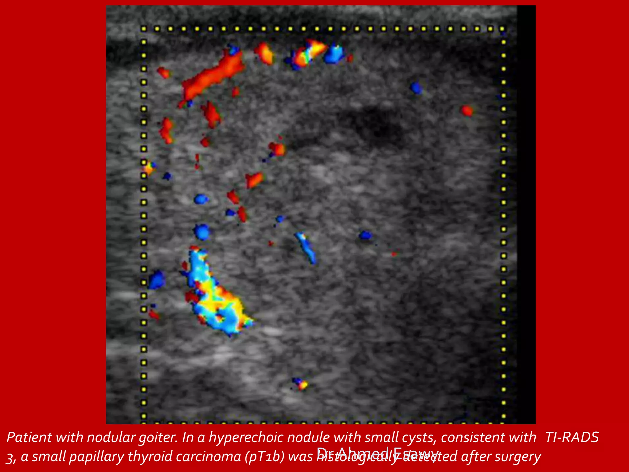 TIRADS (thyroid nodule imaging reporting and data system) Dr Ahmed ...